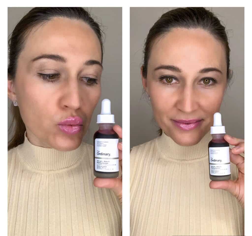 The Ordinary Peeling Solution Review - Is it worth the hype? - The Pink ...